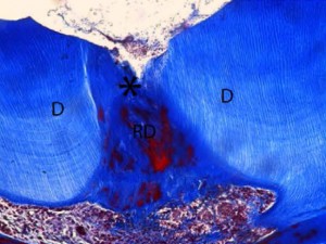 Researchers Develop Novel Method to Repair Teeth using Alzheimer’s Drug ...
